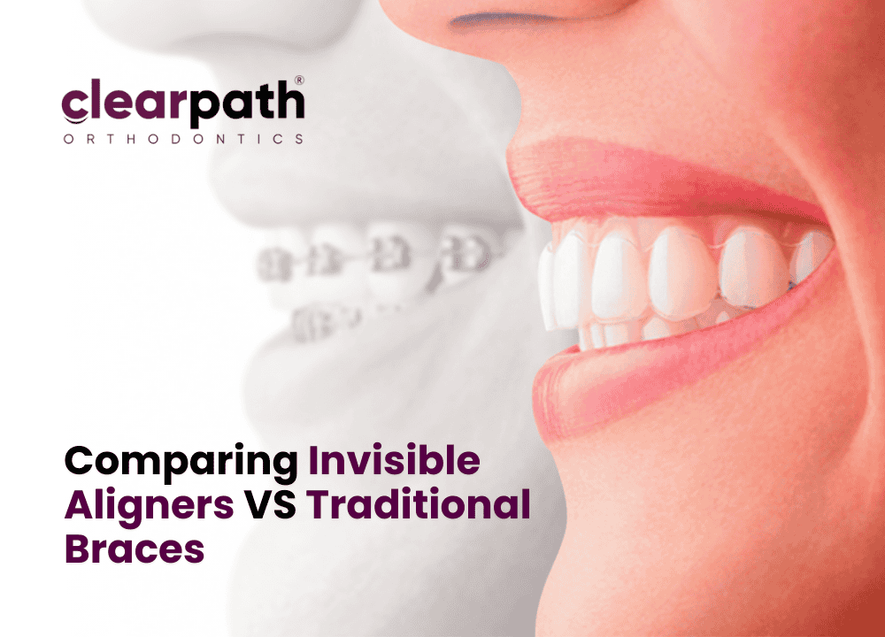 Comparing Invisible Aligners Vs Traditional Braces