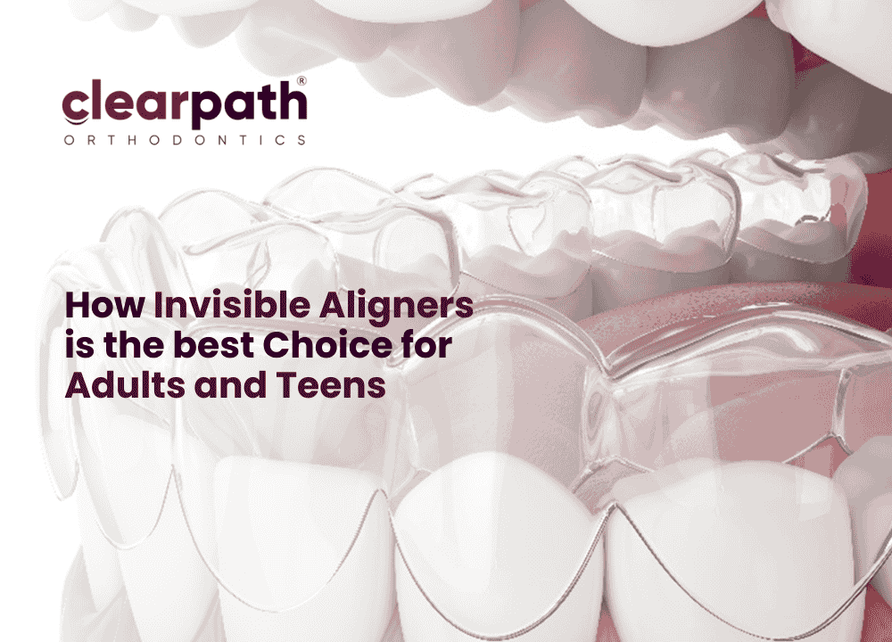 How Invisible Aligners is the best Choice for Adults and Teens